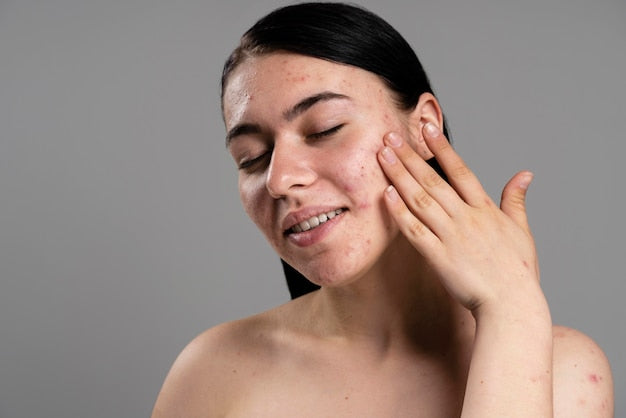 How To Clear The Face Pimples - Follow these 5 steps! – LushVitality